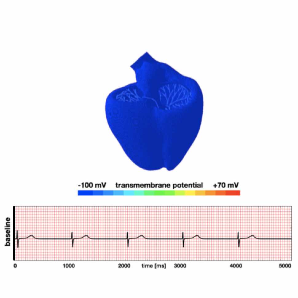 Living Heart Project: Using HPC in the Cloud to Save Lives | Inside HPC ...